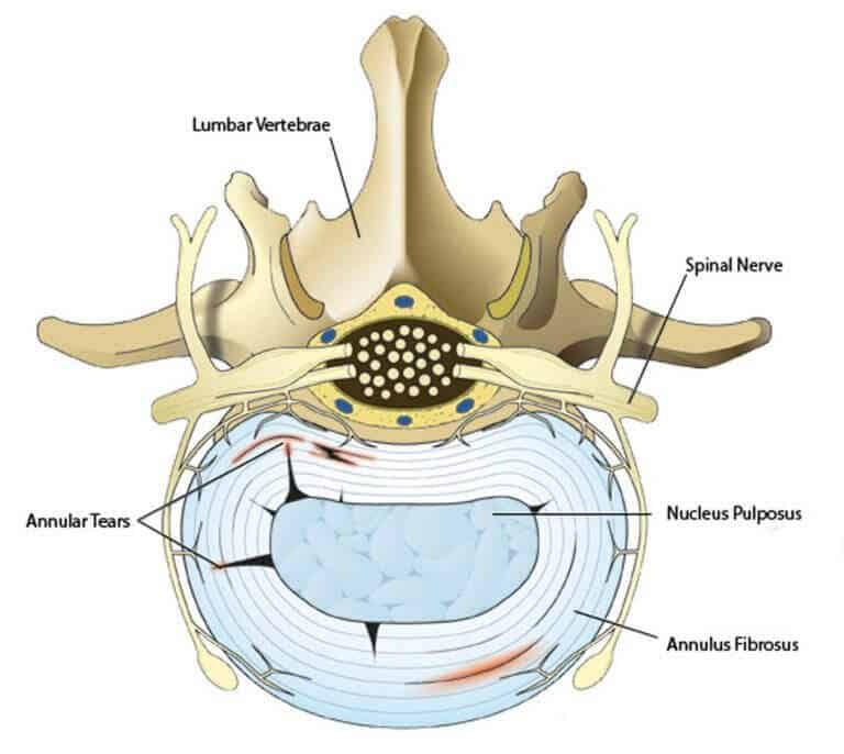 Annular Tear St Louis Pain Consultants